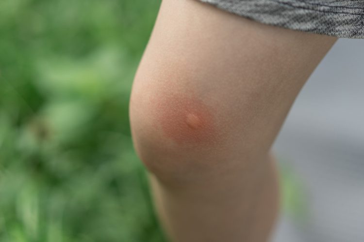 How to Treat an Infected Insect Bite in Farnham Common?
