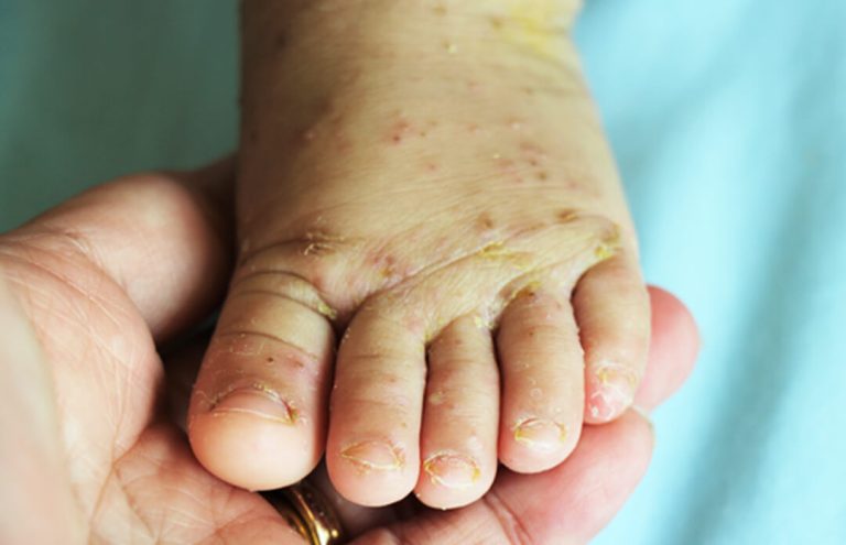 What is the Difference Between Hand, Foot & Mouth Disease & Impetigo?