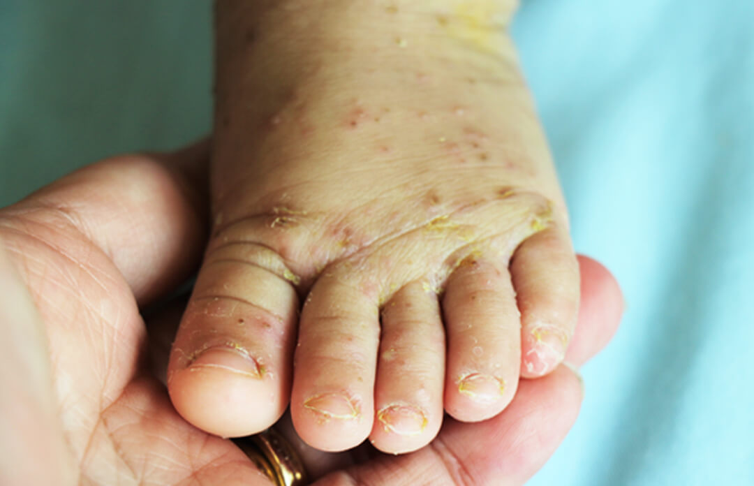 What is the Difference Between Hand, Foot & Mouth Disease & Impetigo?