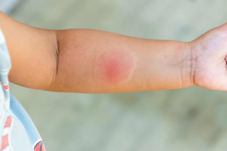 Best Treatment for Insect Bites: When to Seek Medical Attention - Aroga ...