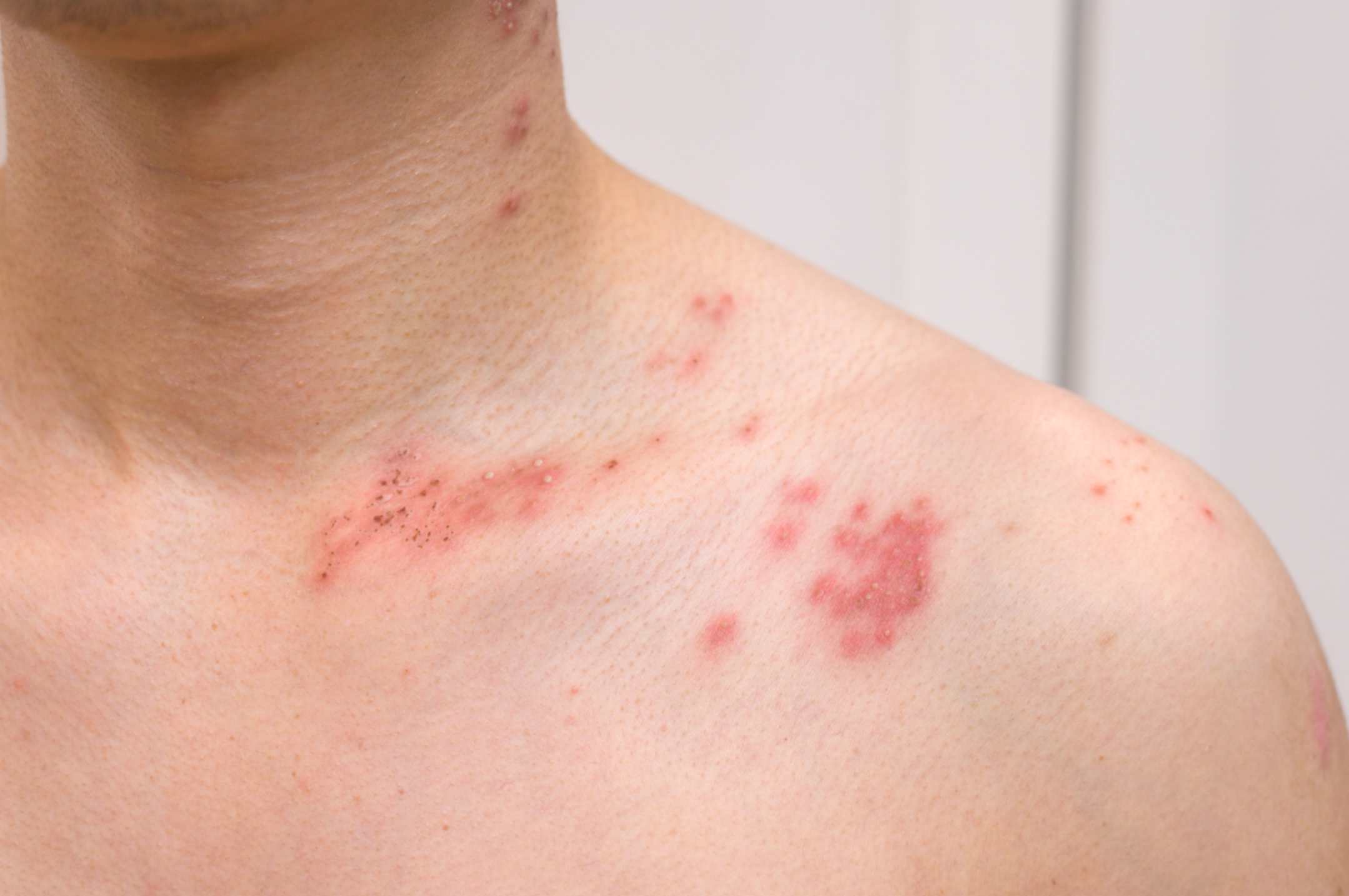 Understanding Shingles: Symptoms & Treatment
