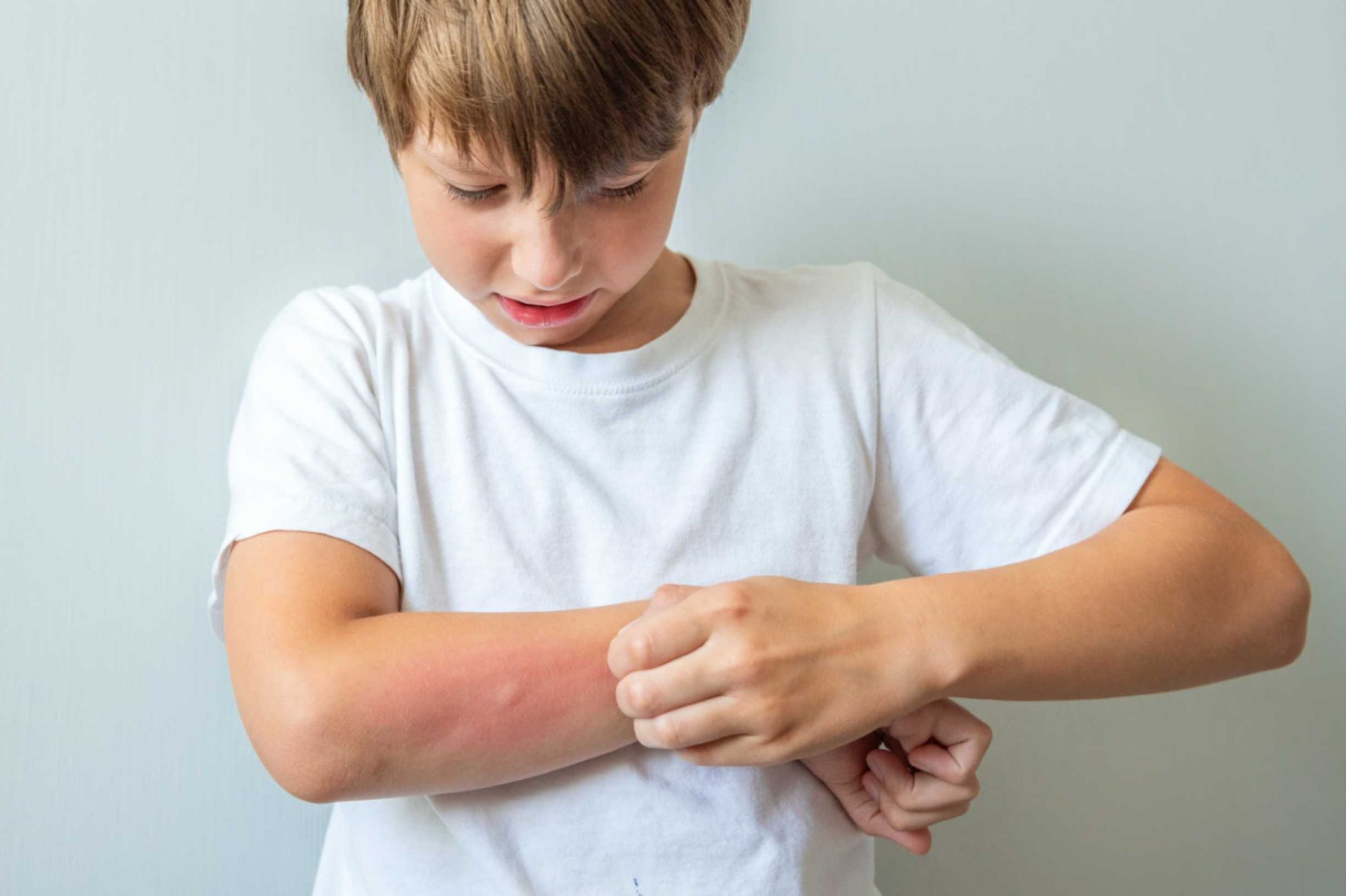When Should You Worry About an Insect Bite Infection? - Aroga Pharmacy