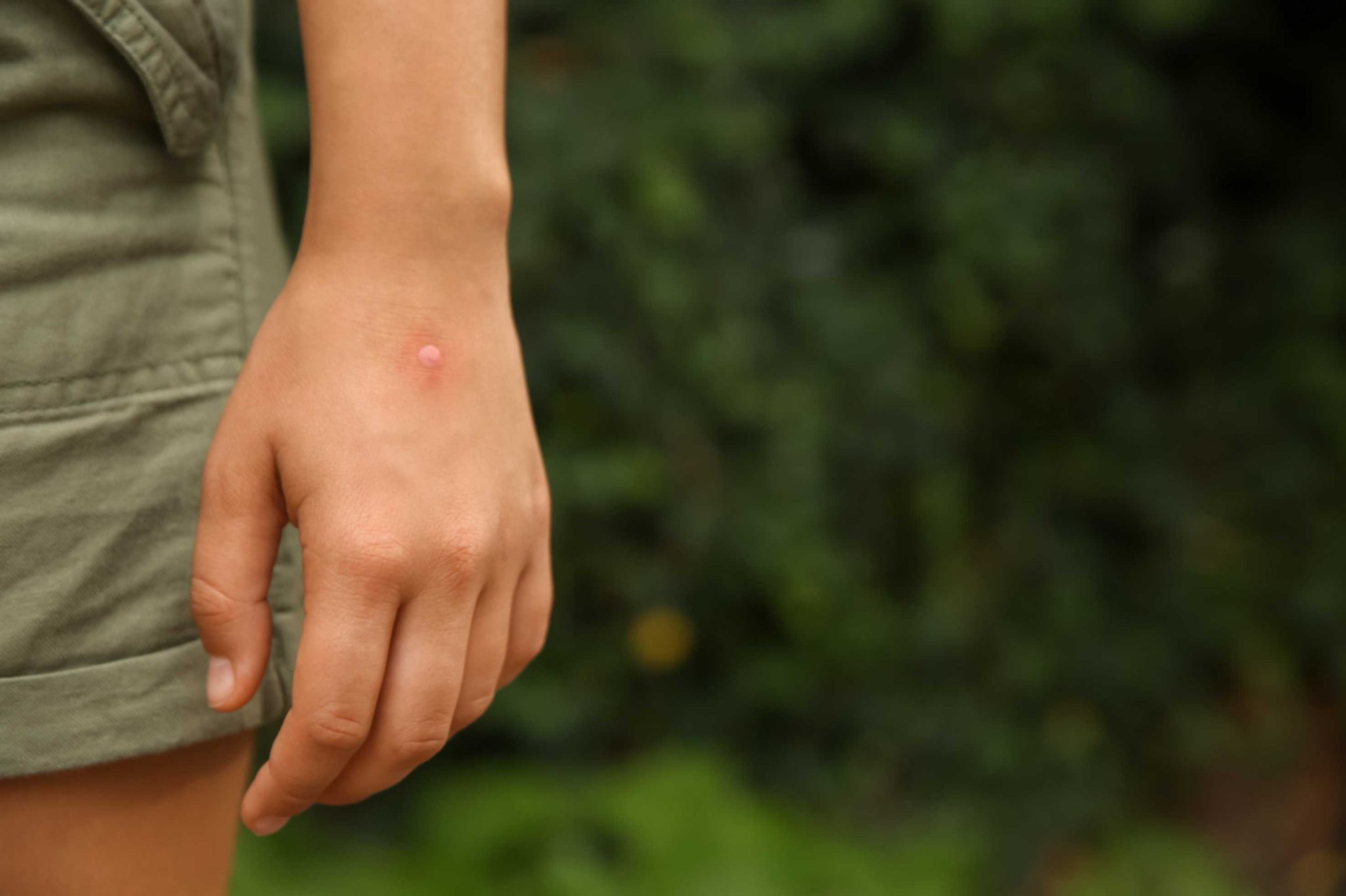 Insect Bite Infection Signs You Should Never Ignore - Aroga Pharmacy